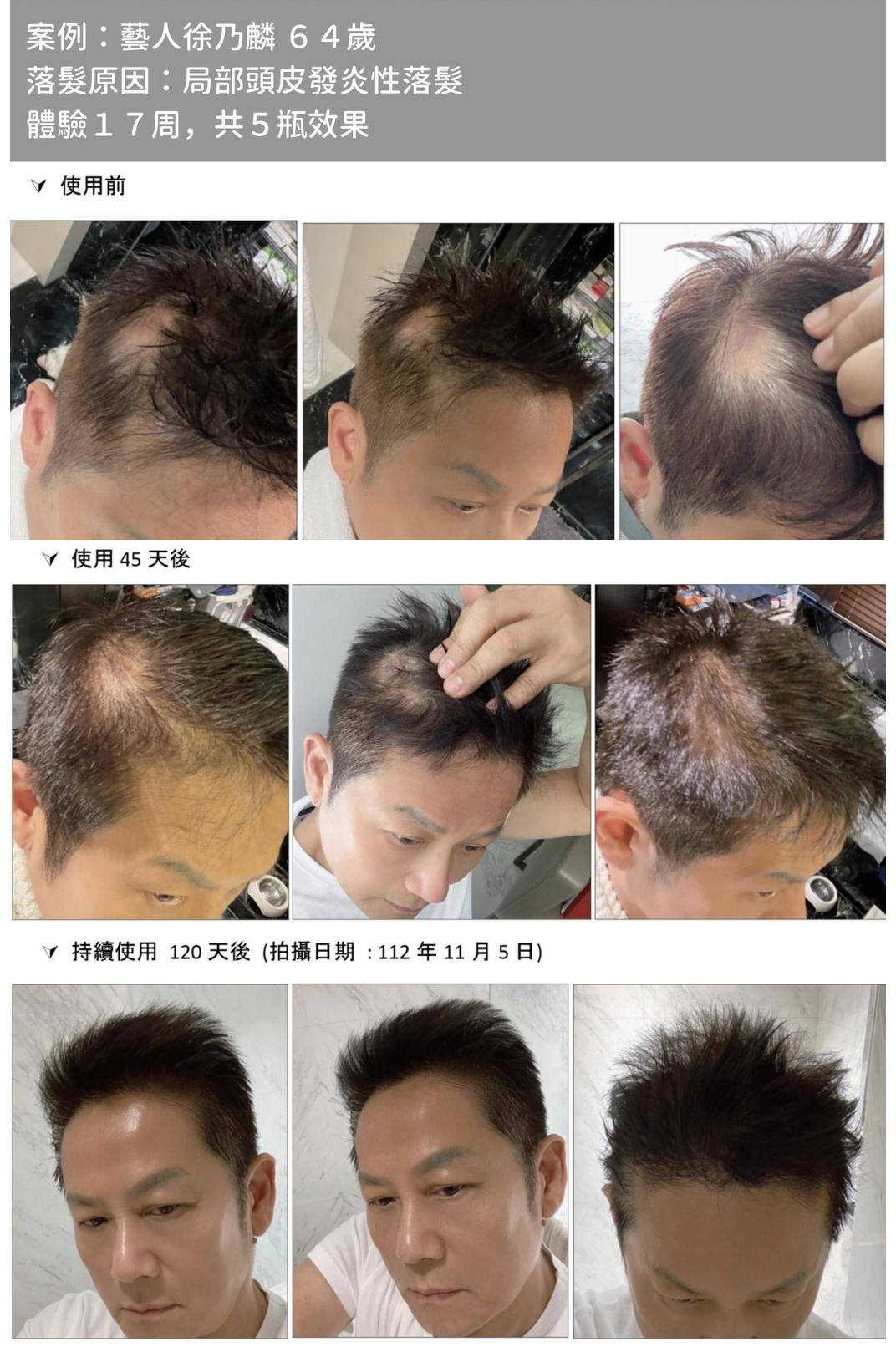 【十盒】髮亮量頭皮滋養液（白金限量版） - Zero2One - KOLNET - 擴大品牌影響力的最佳平台